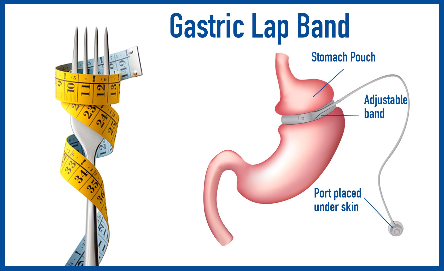 Gastric Band Surgery in Istanbul Turkey All Details - Plastic Surgery