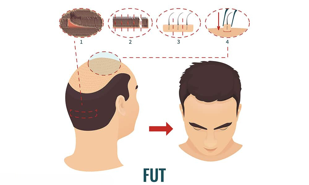 What is Follicular Hair Transplantation? - Plastic Surgery